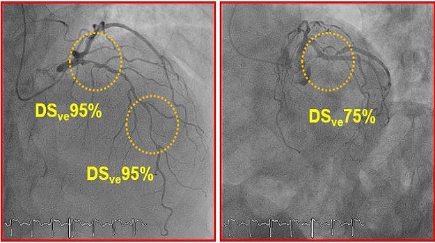 Stable Ischemic Heart Disease - American College of Cardiology