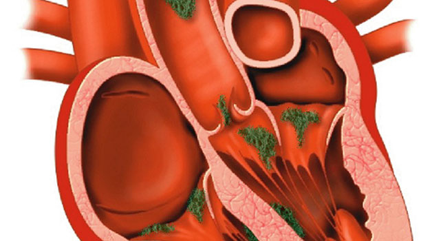 Valvular Heart Disease - American College of Cardiology