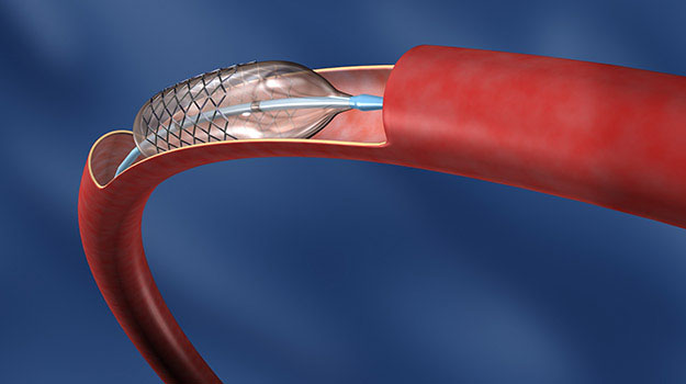 Stable Ischemic Heart Disease - American College of Cardiology